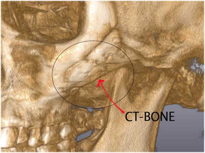 頬骨の再建 -CT-BONEを用いて- | マックスファクス銀座クリニック ブログ